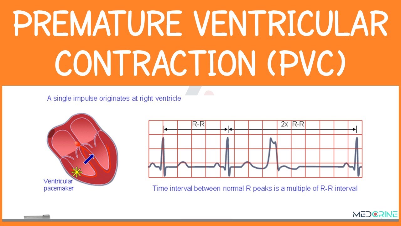 Premature Ventricular Contractions (PVCs) Explained - YouTube