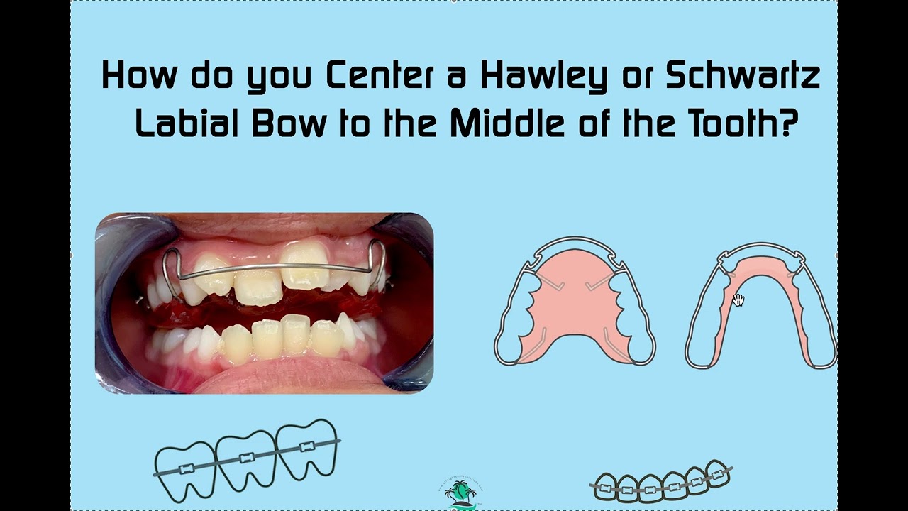 Can you Move a Hawley Labial Bow Up? - YouTube