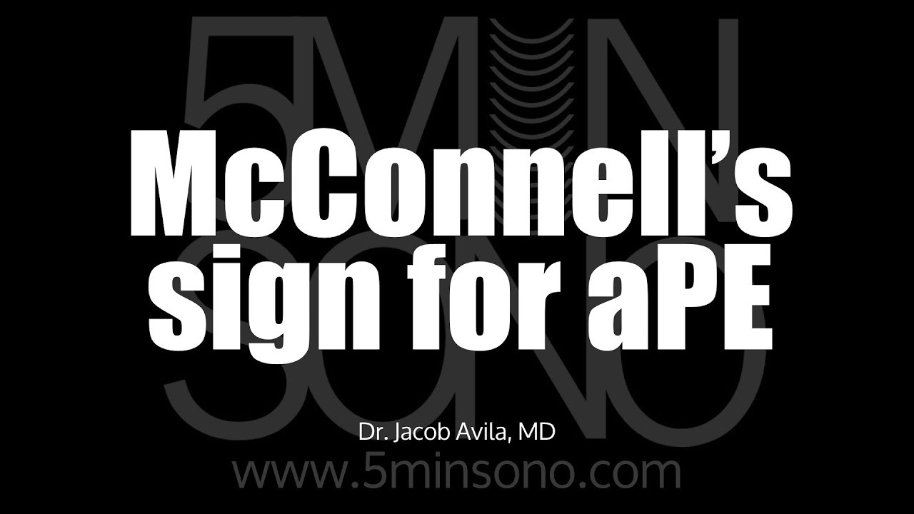 Should we use McConnell's sign for acute PE? - YouTube