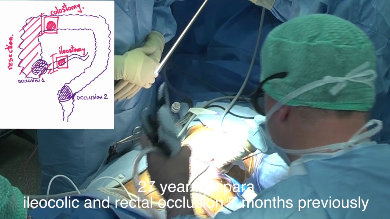 Laparoscopic colorectal resection for bowel occlusion due to ...
