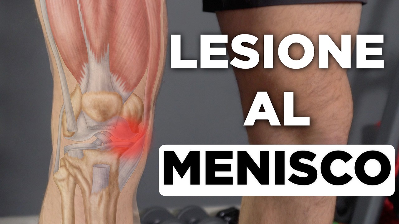 LESIONE e ROTTURA del MENISCO: la GUIDA COMPLETA (cause, esercizi ...