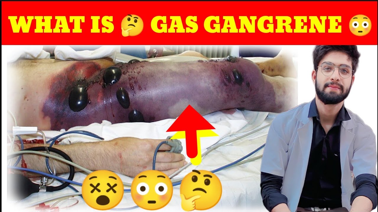 Gas Gangrene | Clostridial Myonecrosis | Symptoms and treatment of Gas ...
