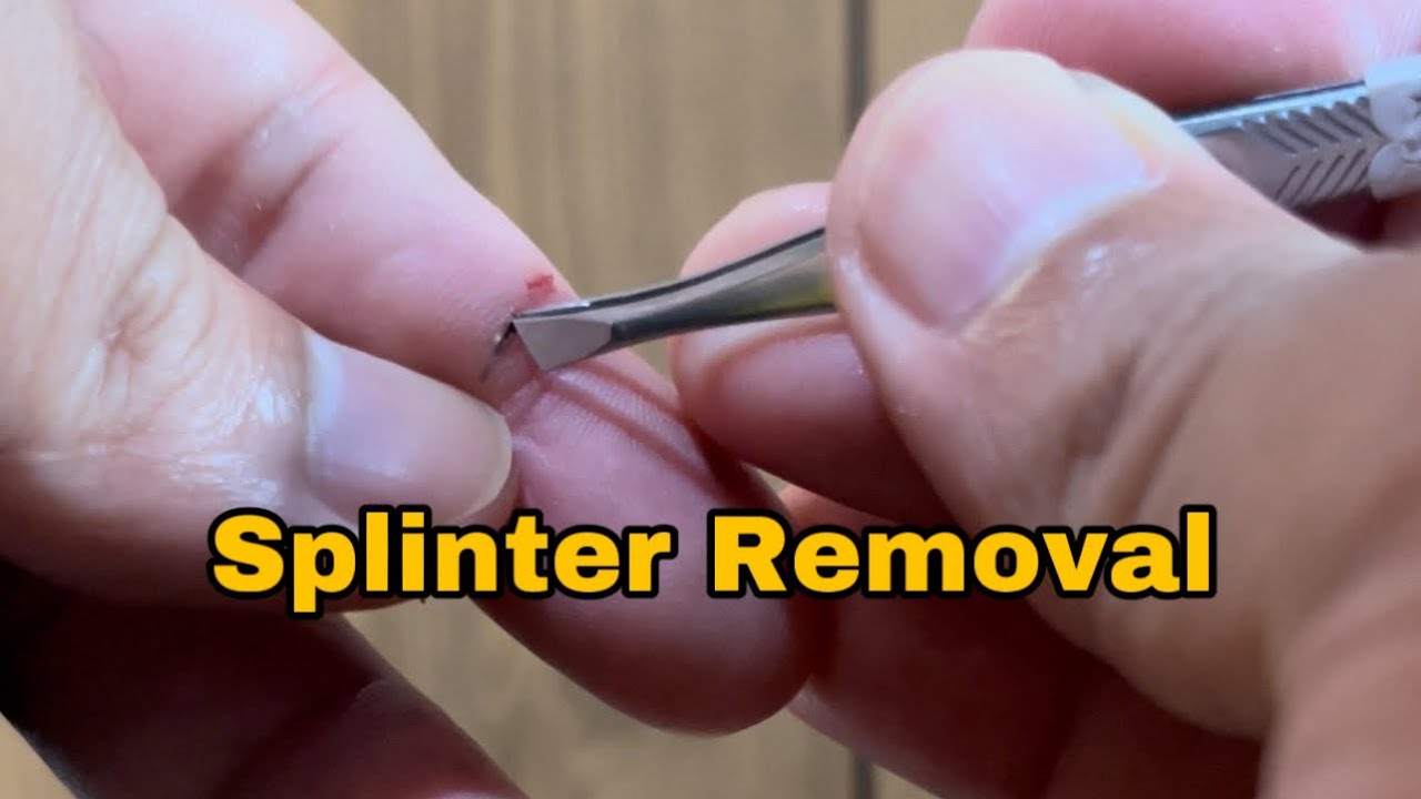 How to remove splinters - YouTube