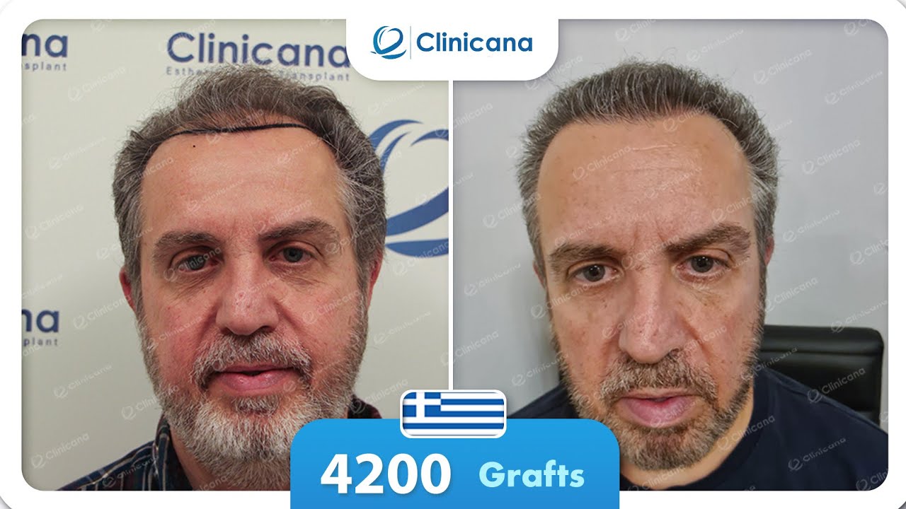 Εμφυτευση Μαλλιων Τουρκια, Το τελικό αποτέλεσμα περιλαμβάνει κριτικές ...