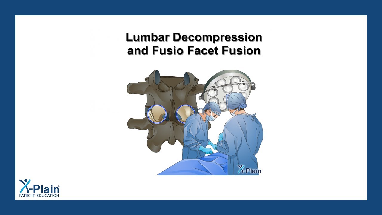 Lumbar Decompression and Fusio Facet Fusion - YouTube