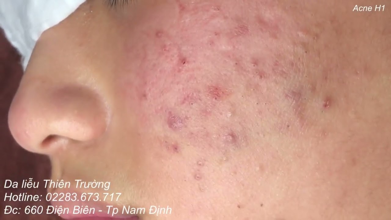 Cách nặn mụn ở má siêu nhiều. Whitehead blackhead, anti acne, severe ...