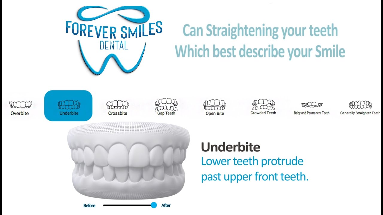 Dentist Baytown. Forever Smiles Dental. 20%-50% OFF Braces. - YouTube