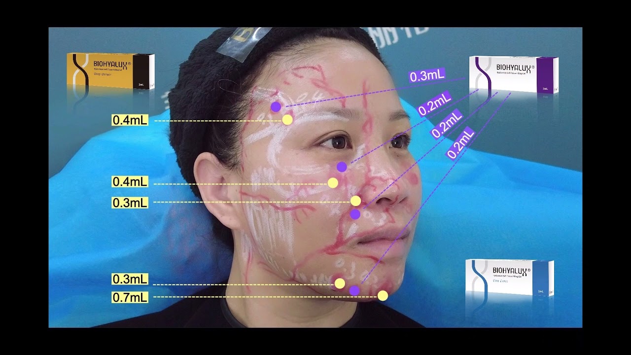 Biohyalux Dermal Filler Injection Video - YouTube