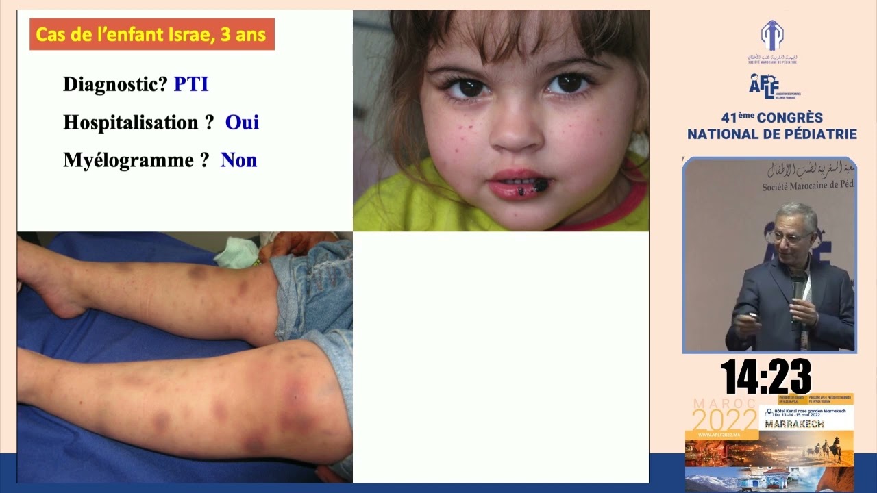 Le Purpura Thrombopénique Immunologique.Pr Mohammed Khattab - Rabat ...