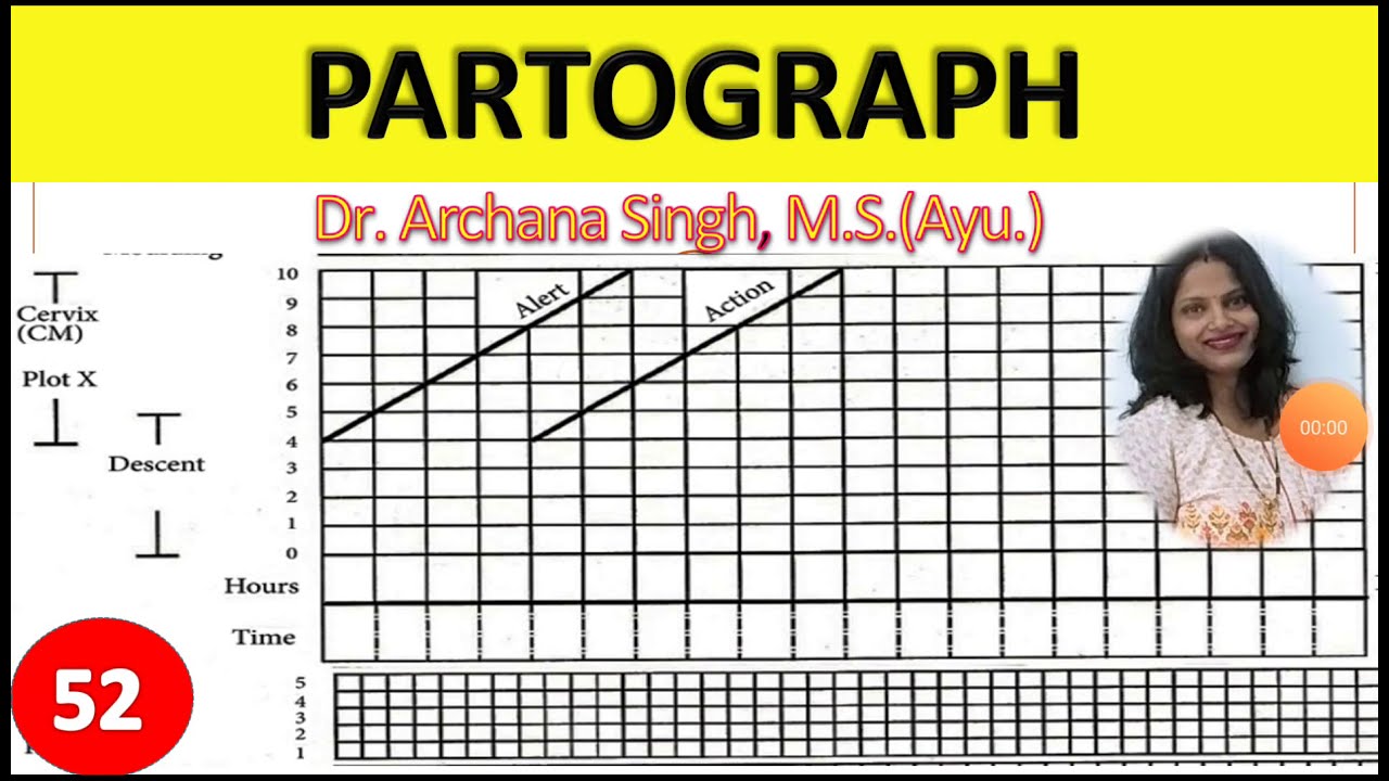 52. Partograph or Partogram. - YouTube