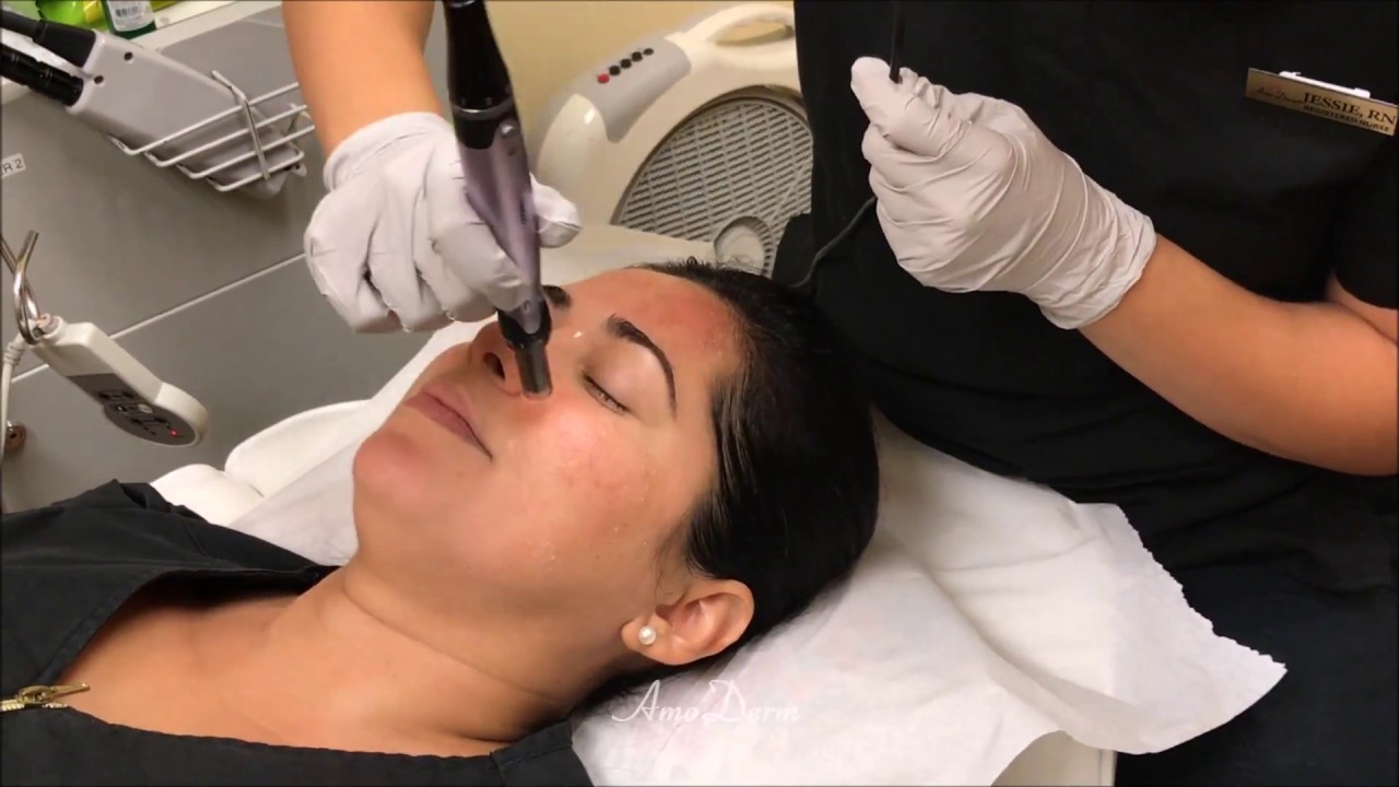 Micro-Needling : rejuvenation treatment for all skin types - YouTube