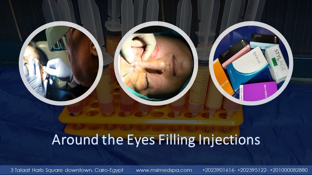 Around the Eyes (periorbital) Rejuvenation. Filling Injections - YouTube