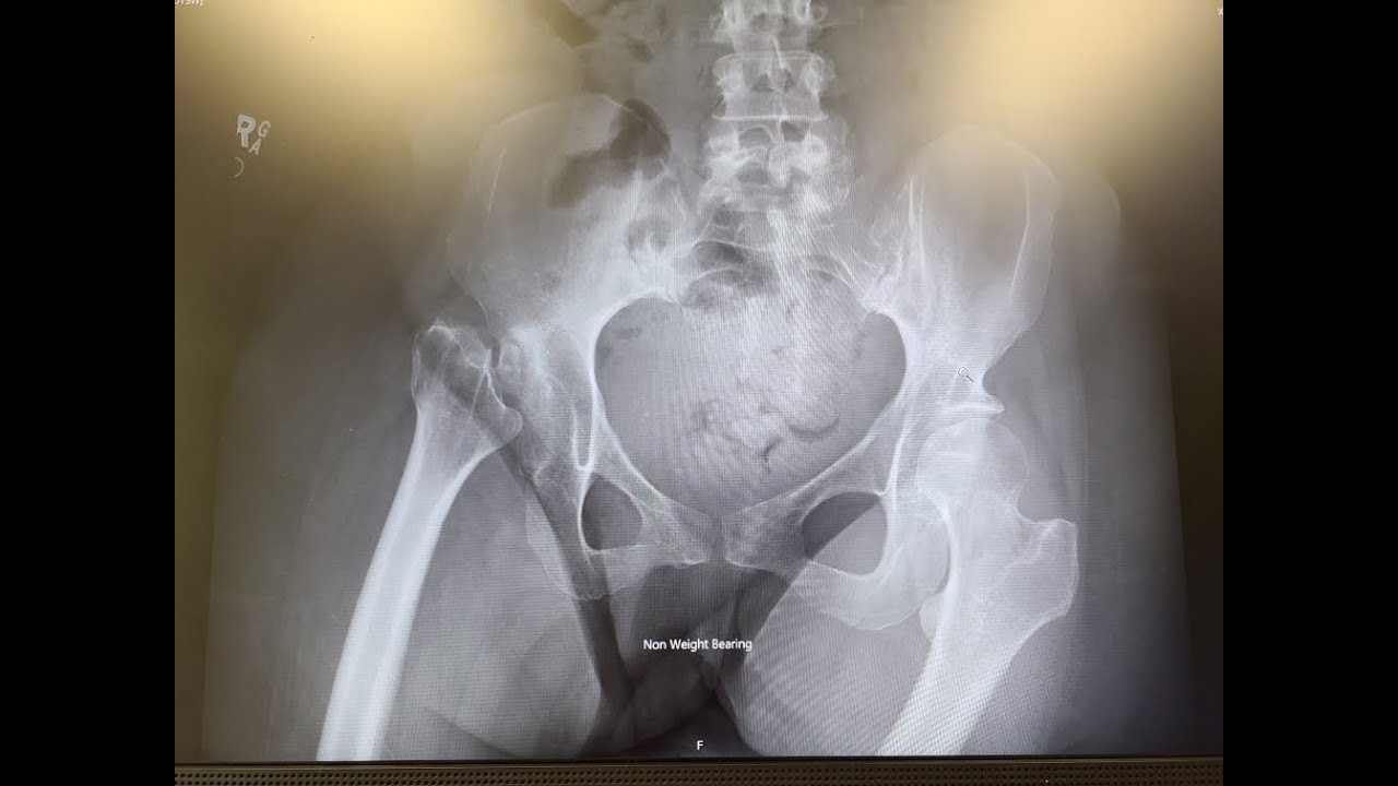 Joey's 4-month Recheck from Girdlestone Resection Surgery - YouTube