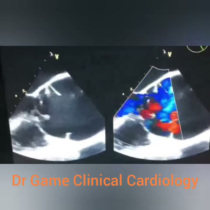 Aortic Regurgitation Echo Clip Youtube