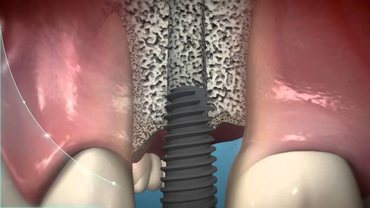 Dental Implant C1 by MIS - YouTube