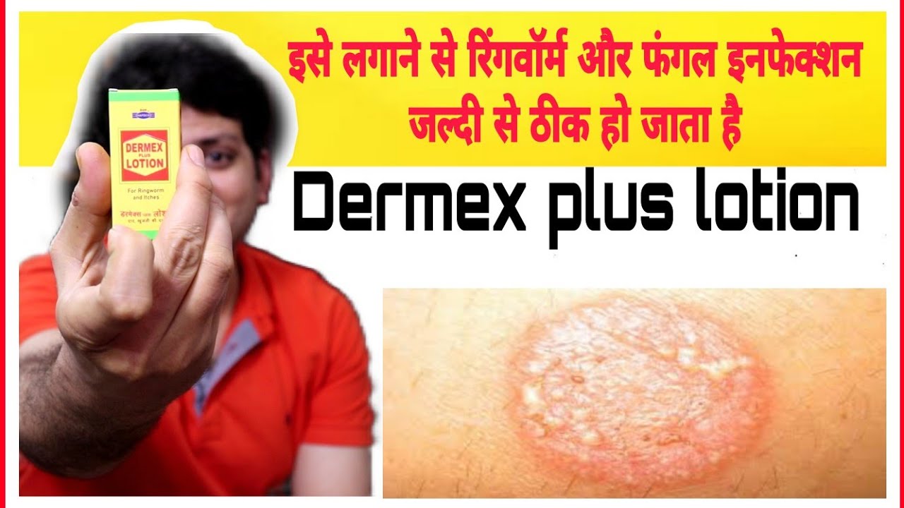 रिंगवॉर्म और फंगल इन्फेक्शन में लगाने के लिए सबसे सस्ता सबसे अच्छा लोशन ...