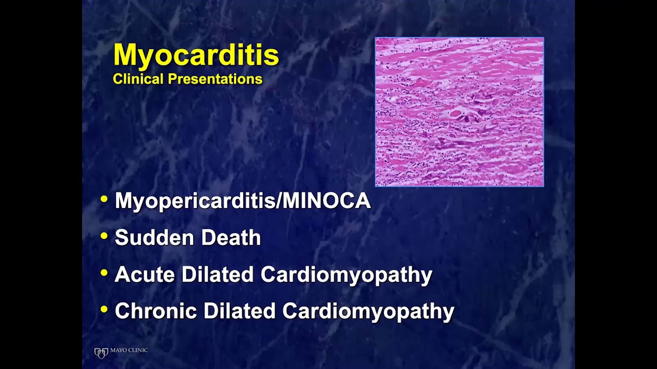 Presentation and Management of Myocarditis in 2021 - YouTube
