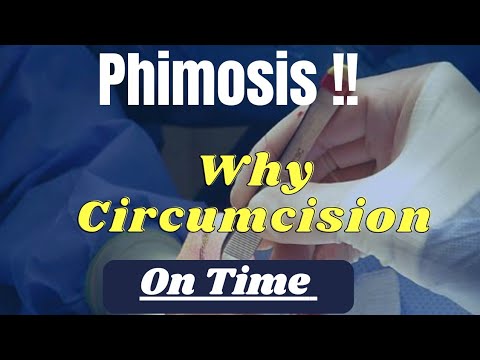 Laser Circumcision For Phimosis