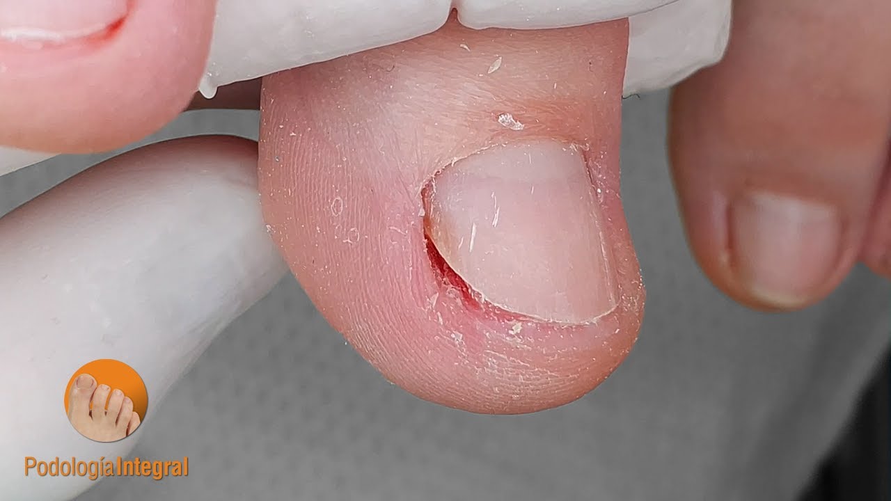 Deep decompression of lateral grooves #podologiaintegral - YouTube