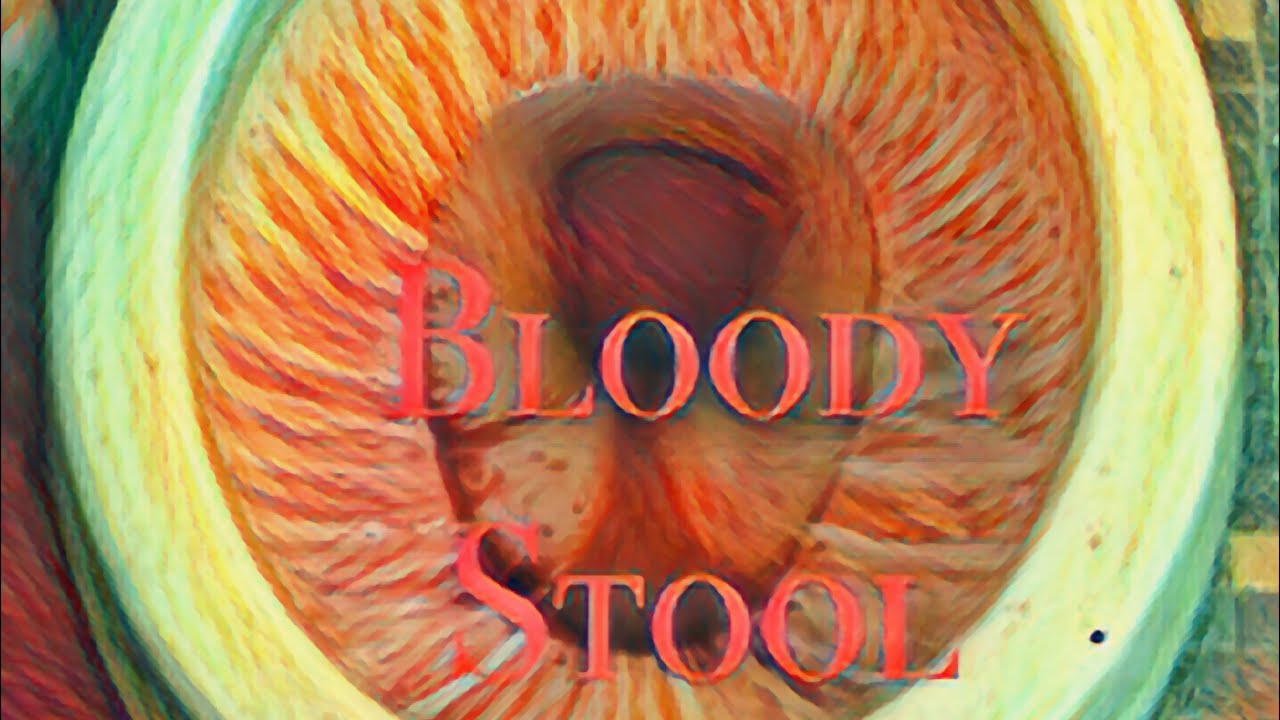 Bloody Stool..5 causes - YouTube