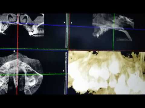 All About Impacted Canines- CBCT . https://www.straightsmilesolutions.com/ - YouTube