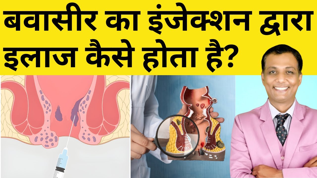 बवासीर का इंजेक्शन द्वारा इलाज कैसे होता है? How Injection Treatment ...
