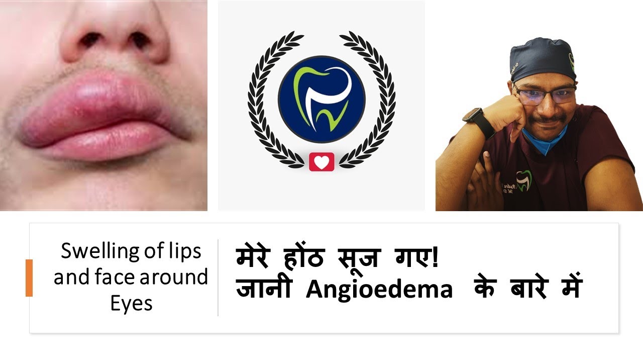 Dr Rudra Mohan| मेरे होंठ सूज गए!| Angioedema | Swelling of lips and ...
