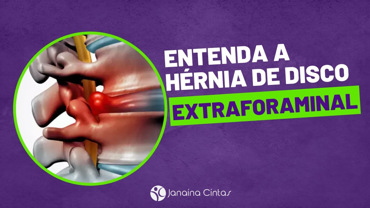 Entenda a hérnia de disco extraforaminal - YouTube
