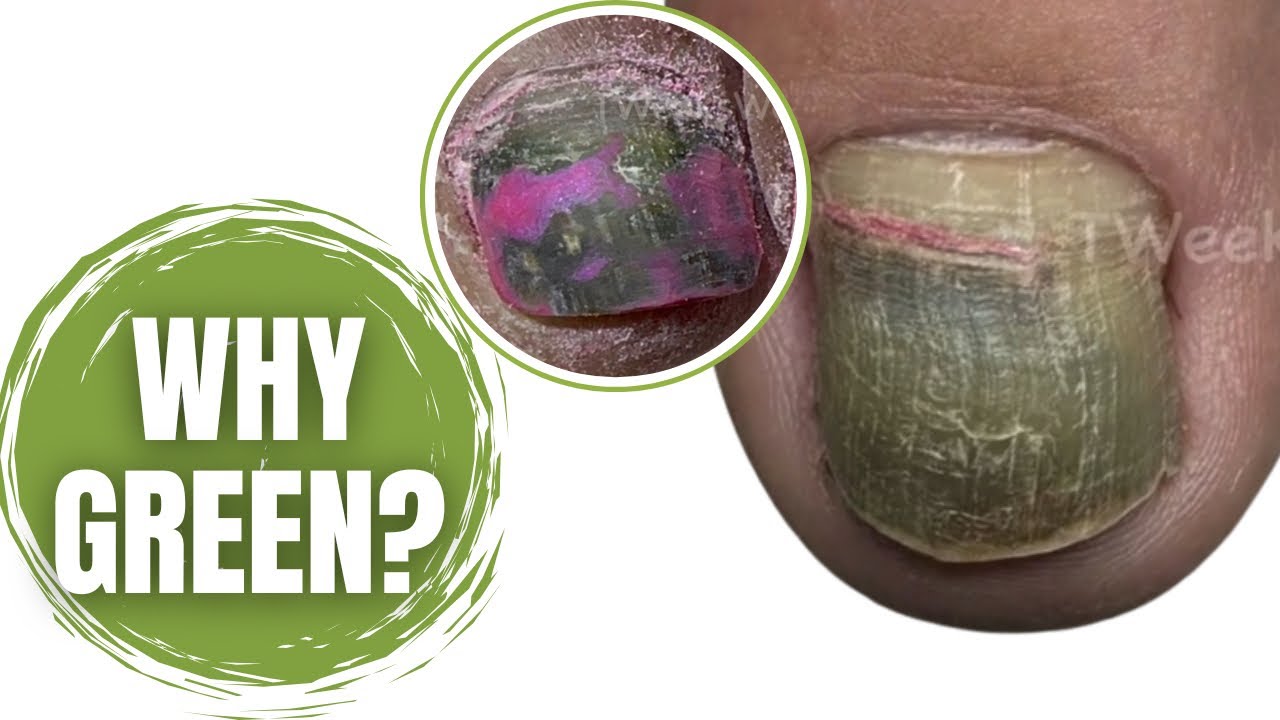 Green Toenail Transformation | Bacteria & Fungus Cleanup - YouTube