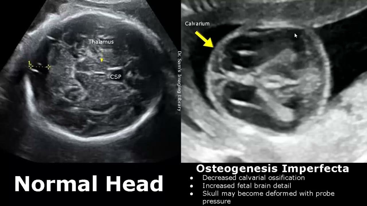 Fetal Stomach Ultrasound Normal Vs Abnormal Image App