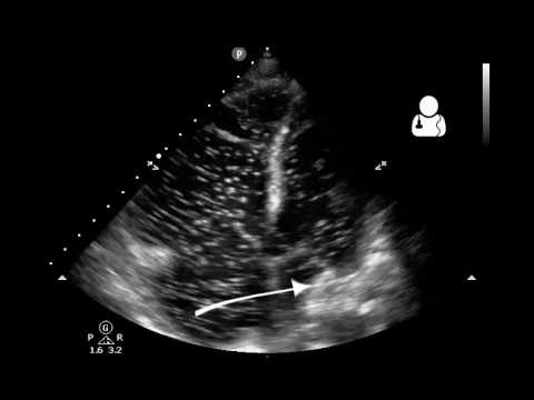 pulmonary embolus echo - YouTube
