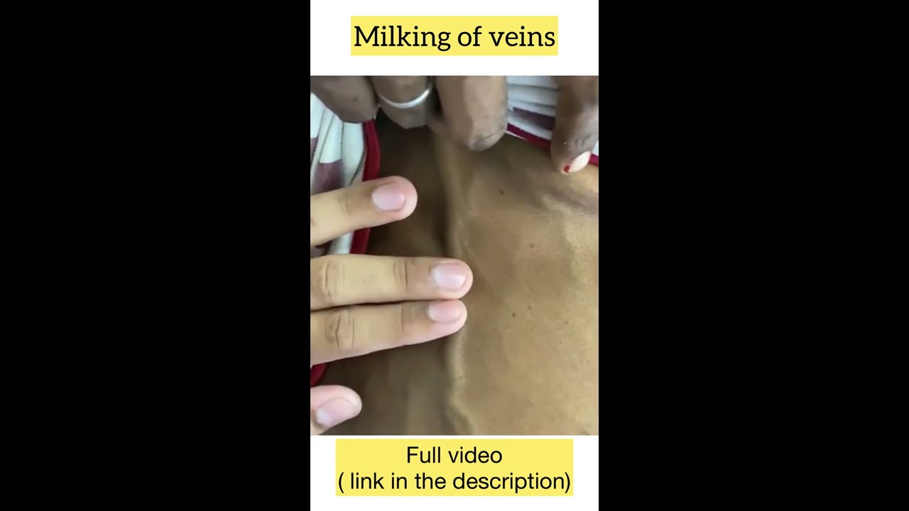 Dilated Abdominal Veins How To Know Direction Of Blood Flow Dilated Abdominal Veins How To Know Direction Of Blood Flow
