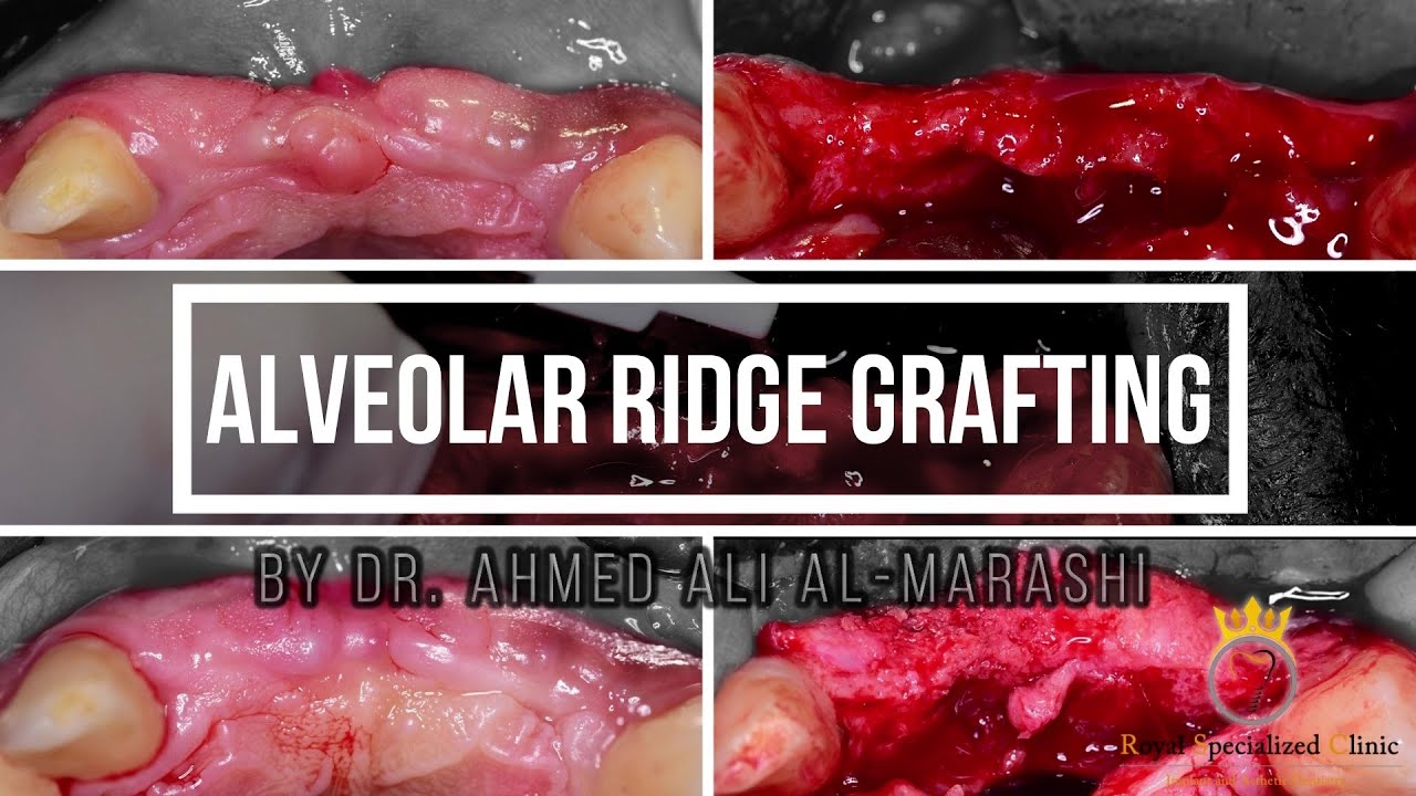 Alveolar ridge augmentation by autogenous bone and allograft - YouTube