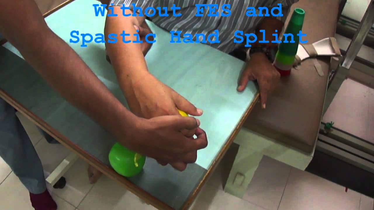 SHS (Spastic Hand Splint) for spastic hemiplegic hand at Hope Neuro ...