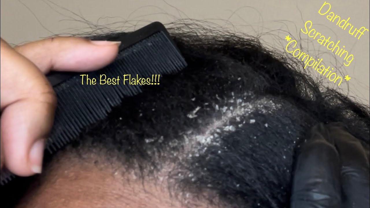 Dandruff Scratching Compilation “Lots of Dandruff Flakes Popping” - YouTube