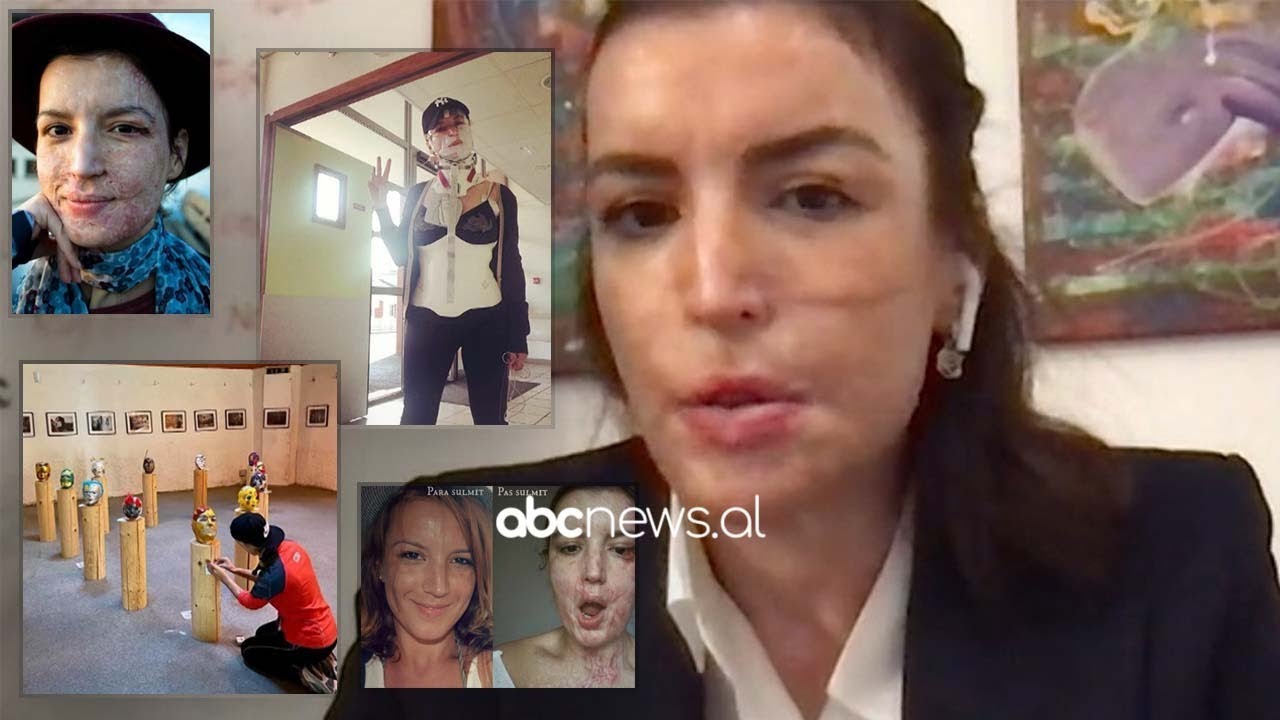 EKSKLUZIVE/ E sulmuan me acid, pas 25 operacionesh Vilma Dule vjen me ...