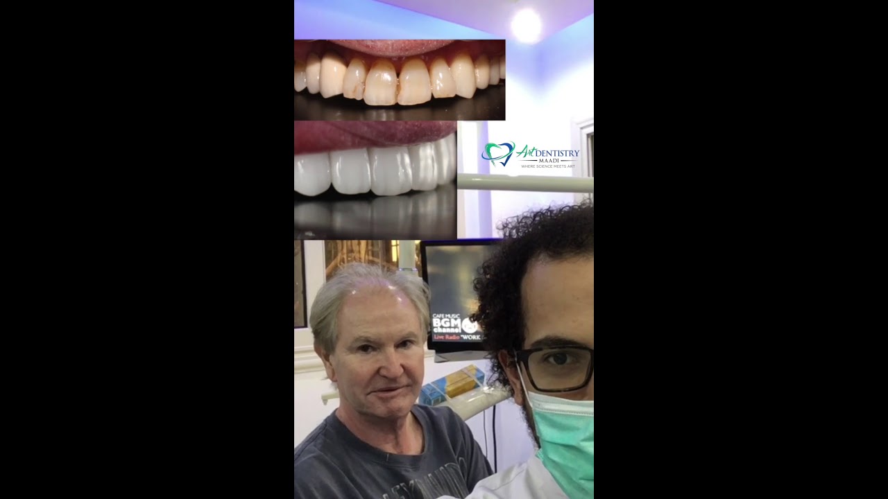 Hollywood Smile Review By Mr Dale Reeves! - YouTube