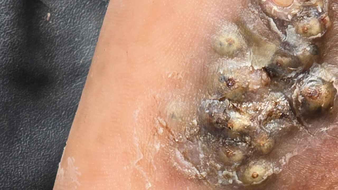 Ondele's left foot jigger digging - SO MANY BUGS - subscribe ...