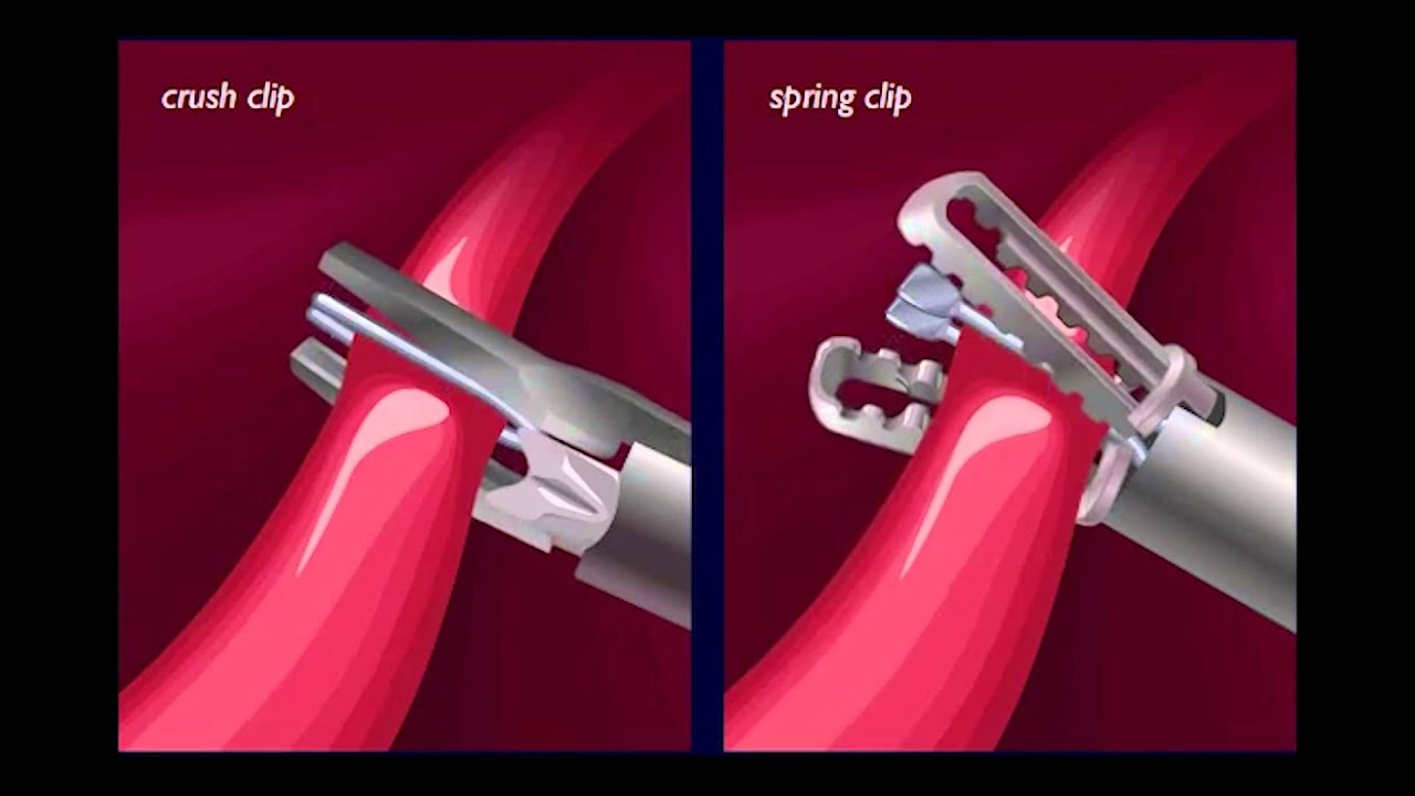 SpringLoc™ 3mm Clip Applier Animation - YouTube