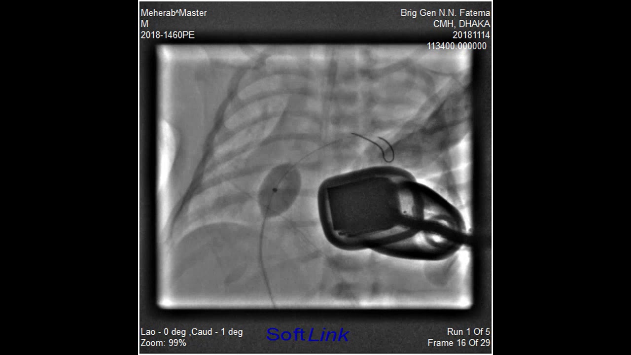 Baby Mehren 01 M 2 8 Kg D TGA , Small ASD II, Small PDA, BAS Done 4 x ...