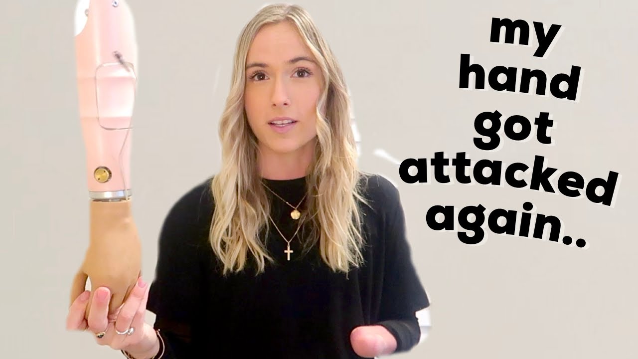 Amputees Final 24 Hours With Hands *My Hand Was ATTACKED* - YouTube