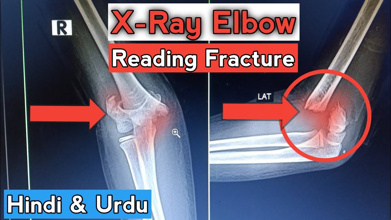 Elbow Fracture and dislocation | everything you need to know about ...