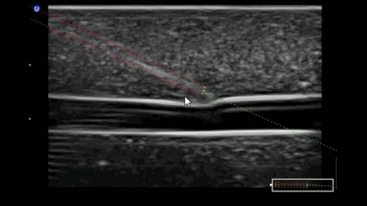 Enhanced Needle Visualization - YouTube