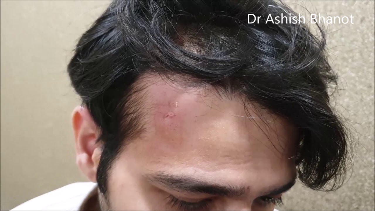 Lipoma on Forehead Treatment | Forehead Lipoma Removal Surgery - YouTube