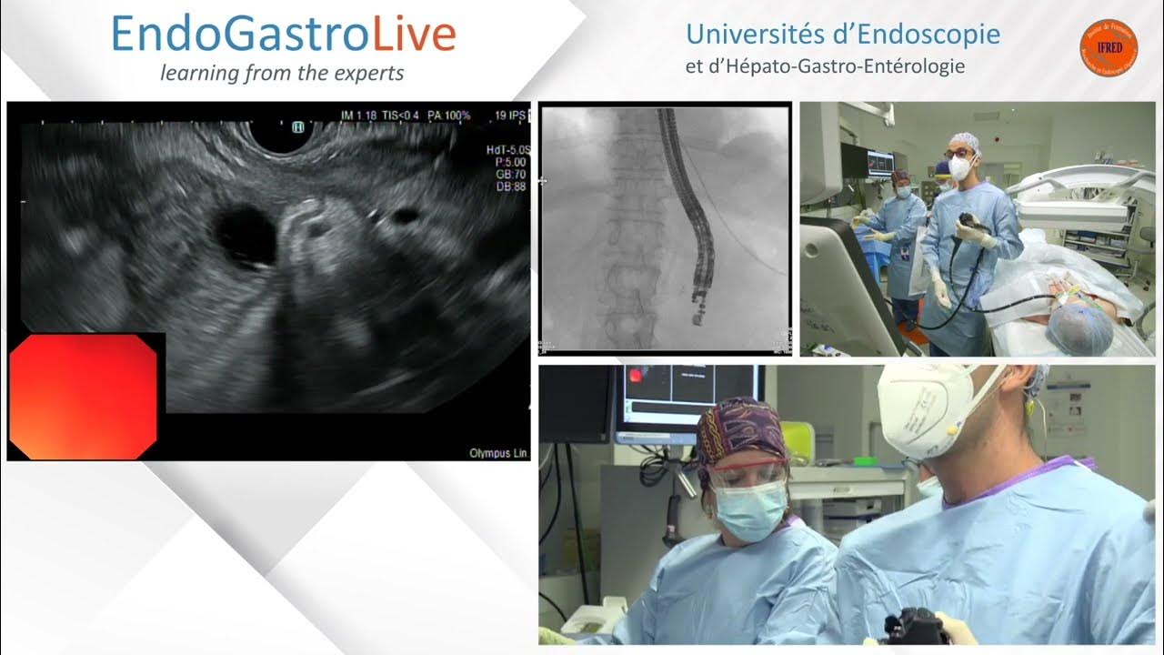 Kystogastrostomie par prothèses double queue de cochon - YouTube