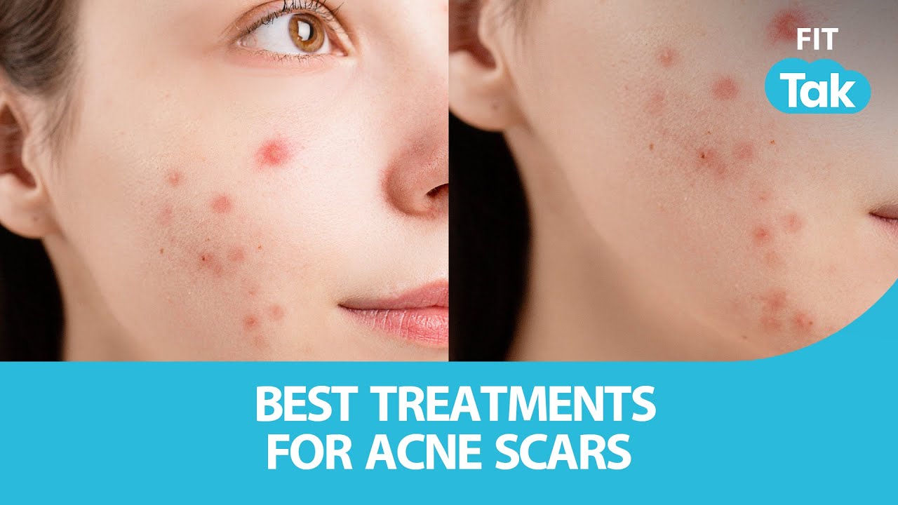 Best Treatments for Acne Scars | Acne Scars | Beauty - YouTube