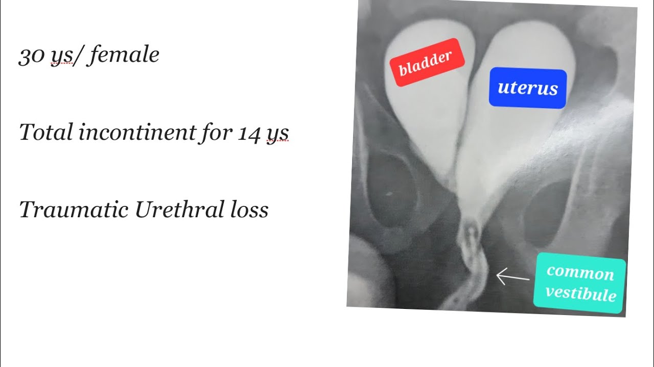 Total female neourethra reconstruction - YouTube