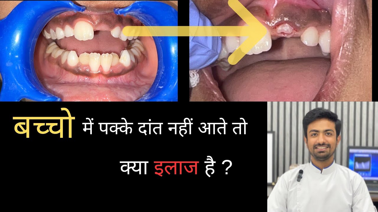 Non-erupting Tooth in kids| Reason and Solution| Surgery Video - YouTube