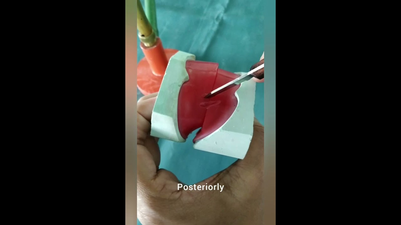 Steps in articulation of complete denture fabrication - YouTube