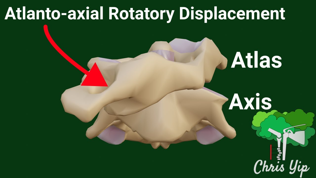 Cock Robin Deformity in Atlanto-axial Rotatory Displacement (AARD ...